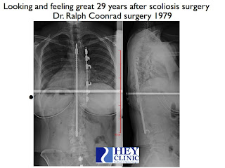 29 years after scoliosis surgery, doing great after Harrington Rod ...