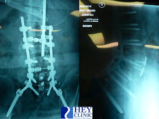 Today's Hey Clinic Scoliosis Surgery: 46 yo 30 yrs sp Harrington Rod ...