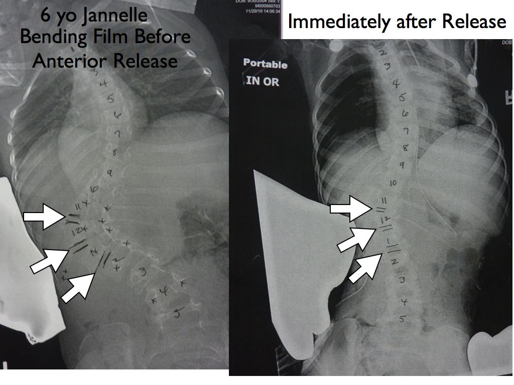 6 yo Janelle’s Shilla Procedure w/ Dr. McCarthy, Arkansas Children’s ...