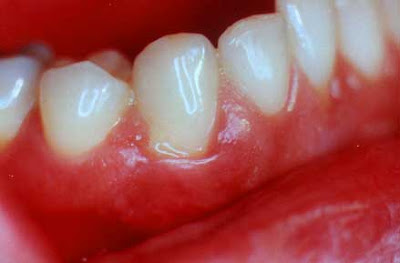 ABCDent: SANGERAREA GINGIVALA