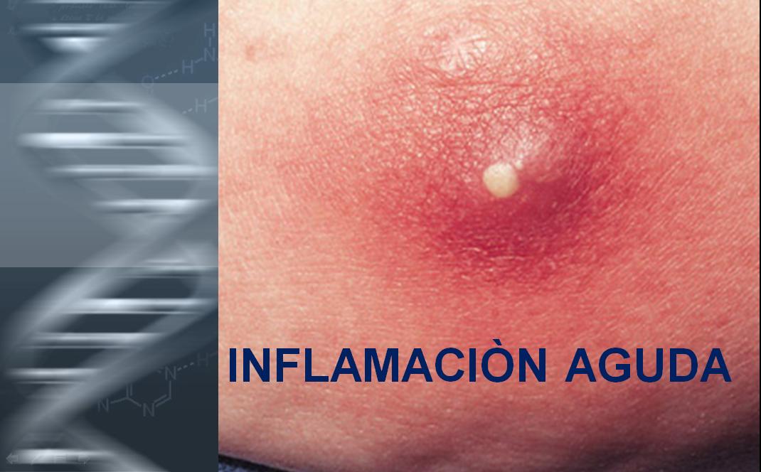 PATOLOGÍA UNC: SEMINARIO 1: INFLAMACIÓN AGUDA
