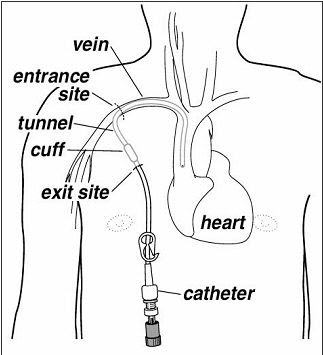 Steve Rider's Web: Hickman surgery successful, still sedated and recovering