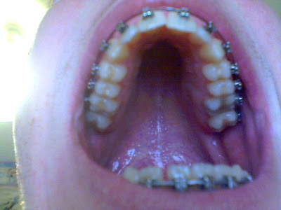 Orthodontie + rétrognathie mandibulaire: 11 mois