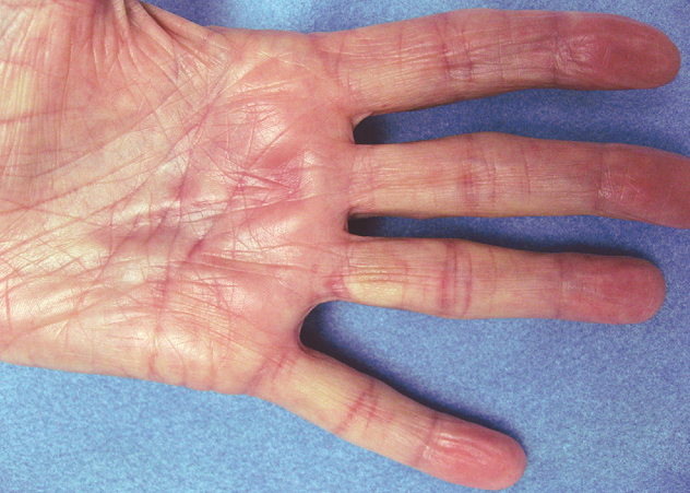 Schmerz Pain 疼痛: New treatments for Dupuytren contracture 注射用XIAFLEX ...