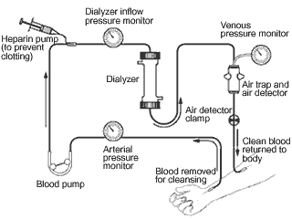 Hemodialysis Devices: Hemodialysis Delivery System