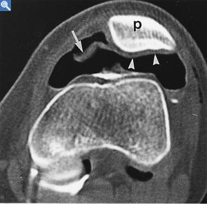 Lesiones de la Rodilla - Luxación de Rótula | Centro Médico Interlomas ...