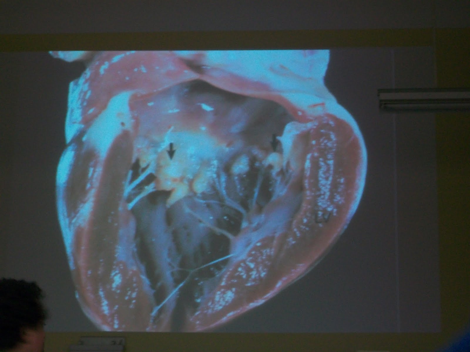 ignafvet: Patologia Sistema Cardiovascular (Endocardio)