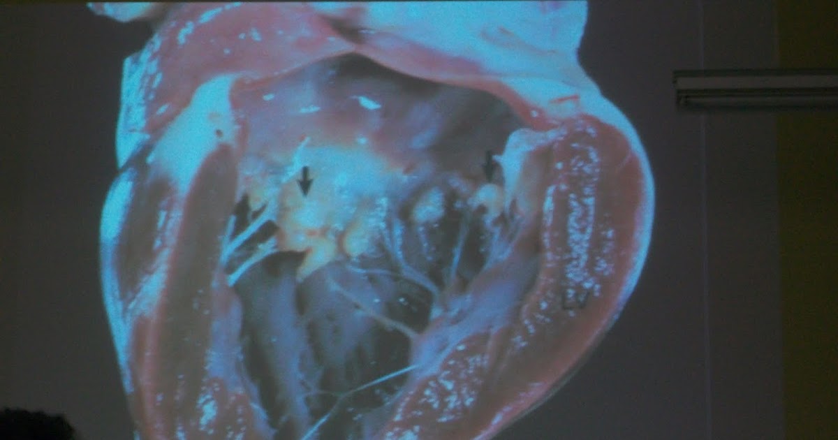 ignafvet: Patologia Sistema Cardiovascular (Endocardio)