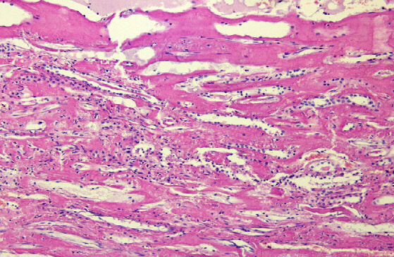 Patologiando: Amiloidose