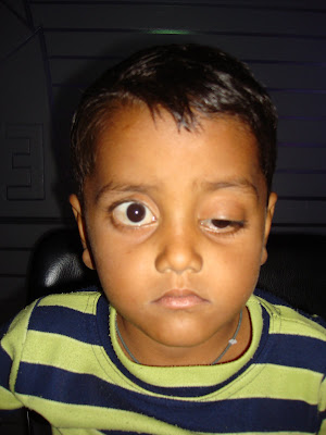 how to take care of your eyes: Congenital ptosis