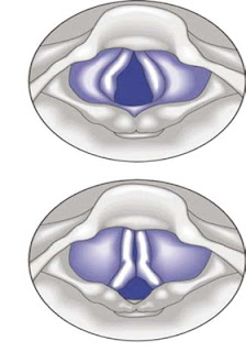 Your Health: Vocal cord dysfunction