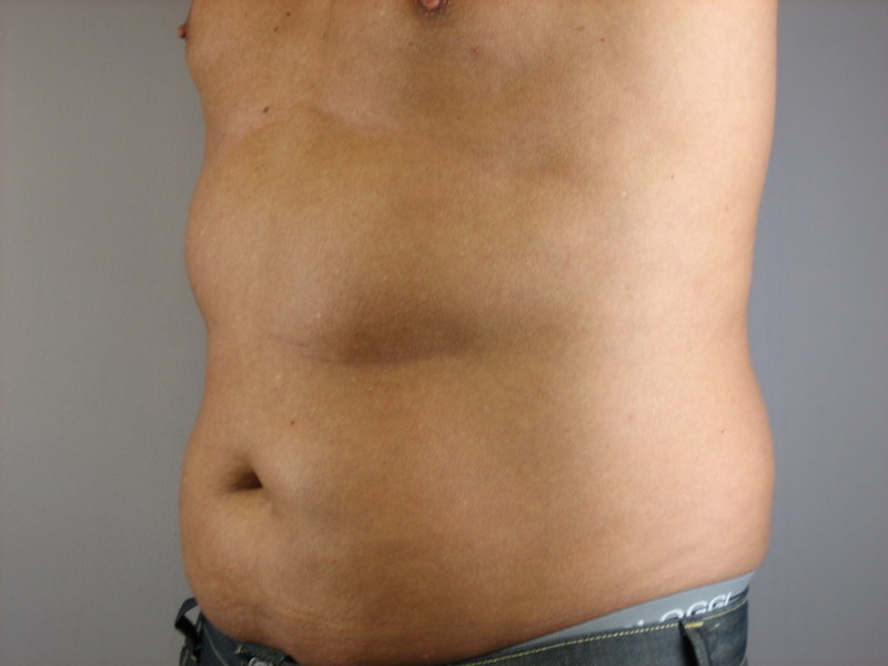 Selston Cosmetic Clinic: Vaser Lipo Mid Def.. ..Result....Male...Age 50