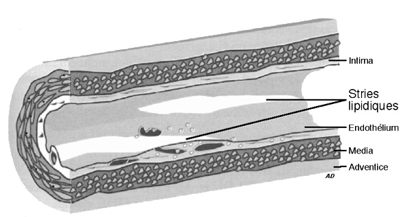 L'athérosclérose