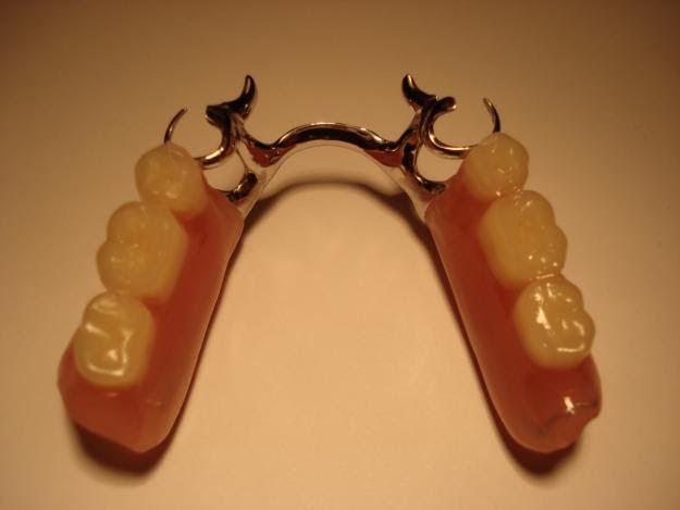 Athenas Laboratório de Prótese Dentária: Prótese Parcial Removível