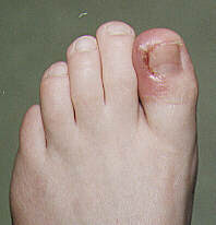 Ingrown Toenail Infection Pictures ~ Ingrown Toenail