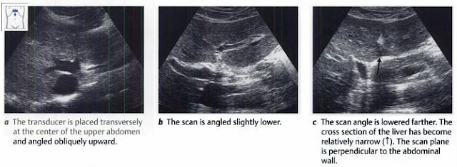 Ultrasound
