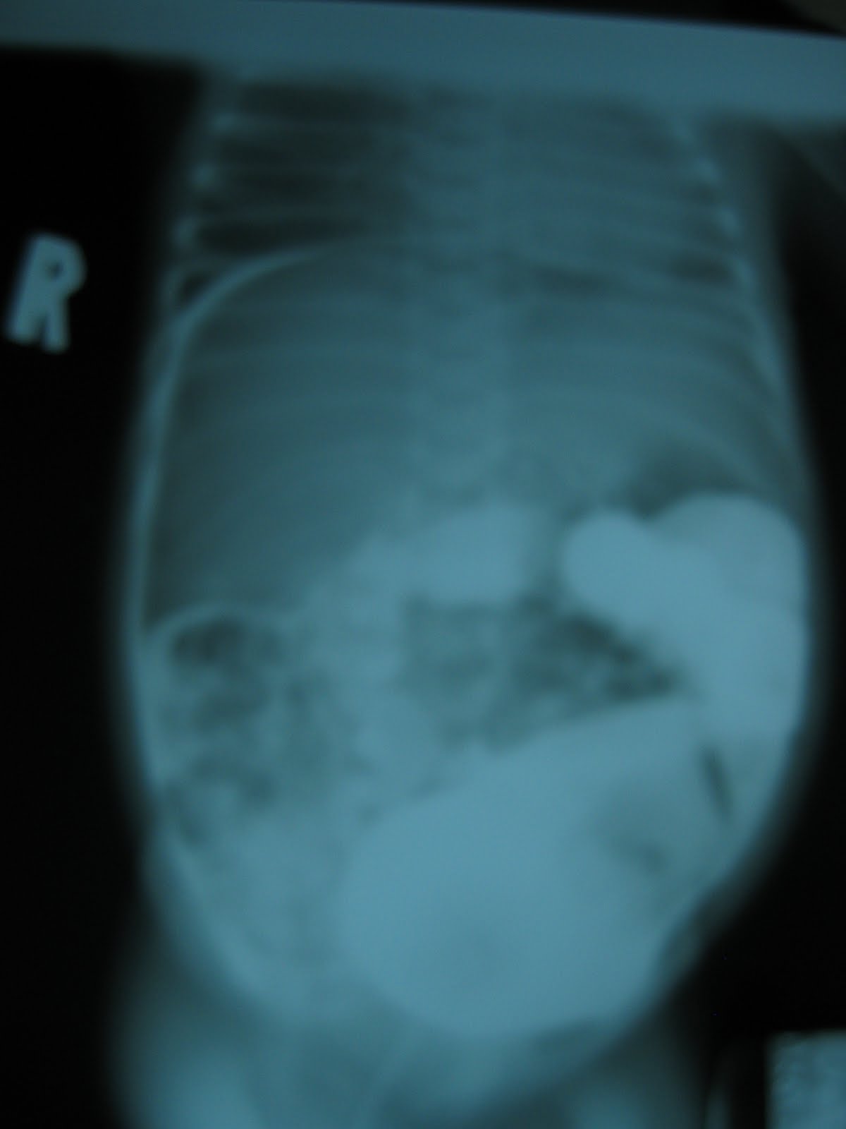 Bedah Anak-RSUD AWS: Komplikasi pemasangan pipa rektal untuk dekompresi ...