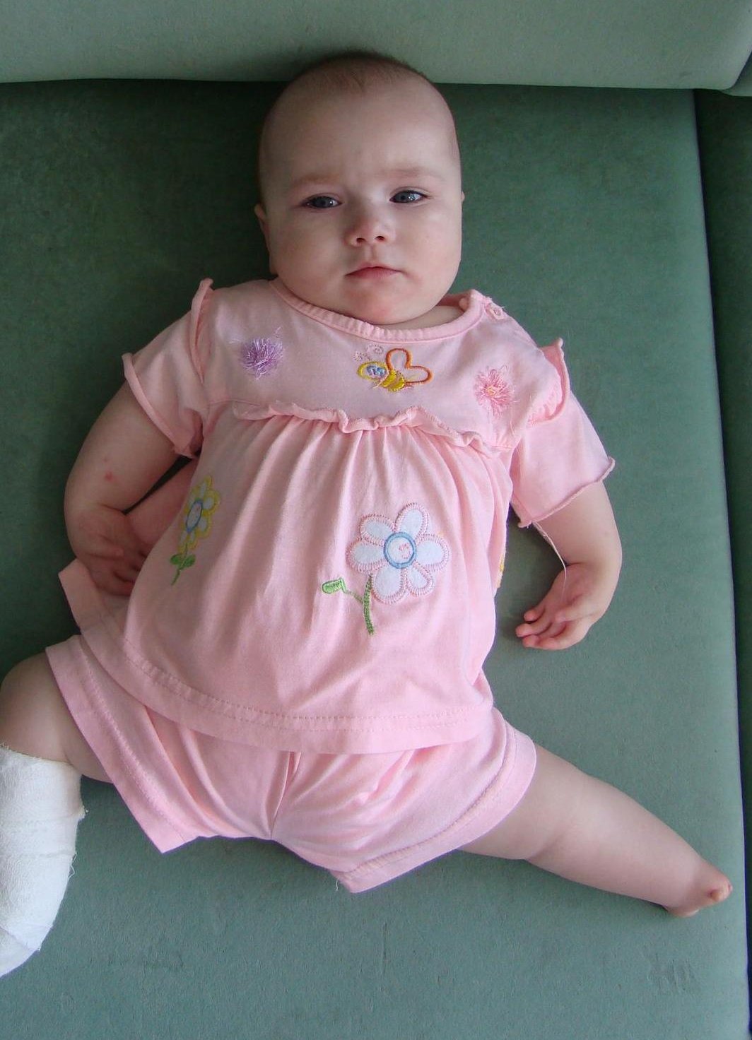 Arthrogryposis; Amyoplasia Congenita; Arthromyodysplasia, Congenital ...