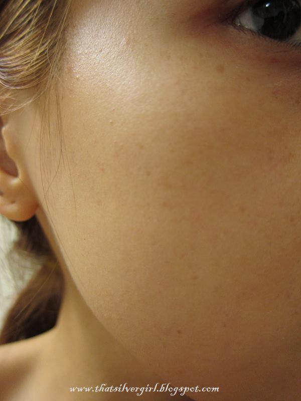 Review: Spotless Skin @ SkinLab Medical Spa