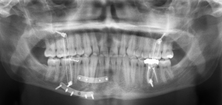 Facial Fractures, Facial Trauma, Facial Reconstruction: Mandible ...