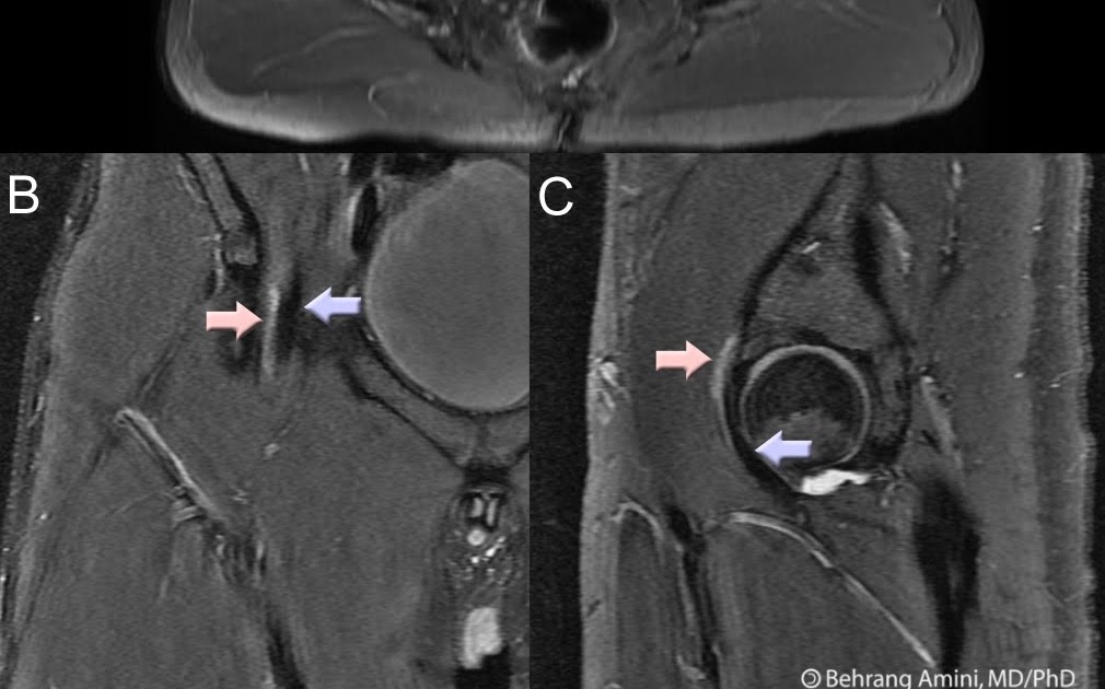 Roentgen Ray Reader: Snapping Hip (Coxa Saltans)