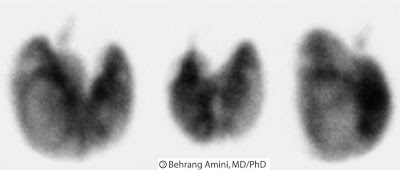 Roentgen Ray Reader: Marine-Lenhart Syndrome