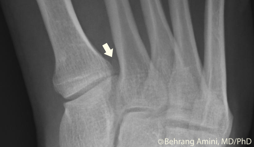 Roentgen Ray Reader: Os Intermetatarseum