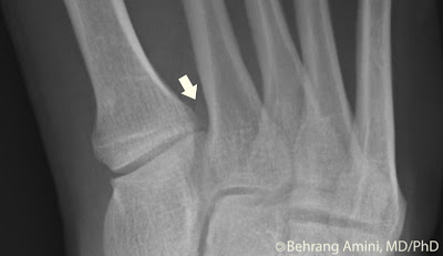 Roentgen Ray Reader: Os Intermetatarseum