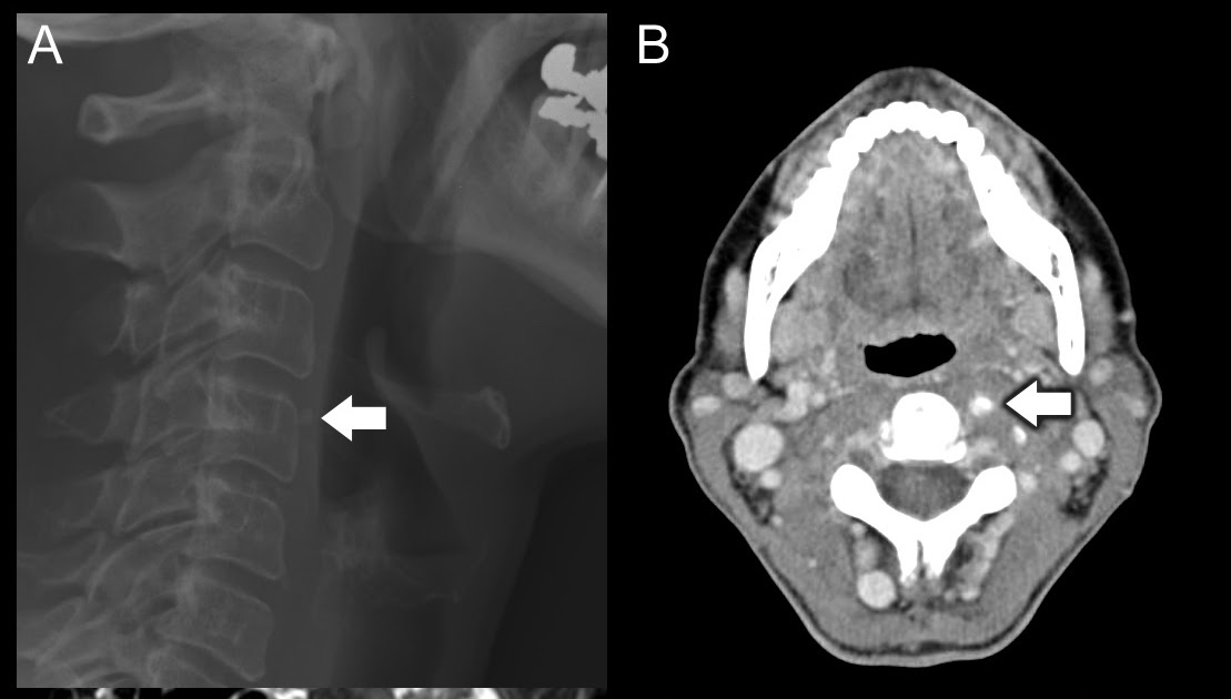 Roentgen Ray Reader: Calcific Tendinitis of the Longus Colli Muscle