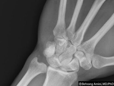 Roentgen Ray Reader: Lunula