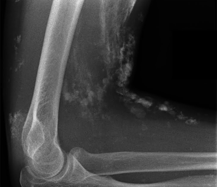 Roentgen Ray Reader: Soft Tissue Calcifications