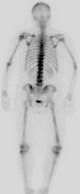 Roentgen Ray Reader: Differential Diagnosis of a "Super Scan ...
