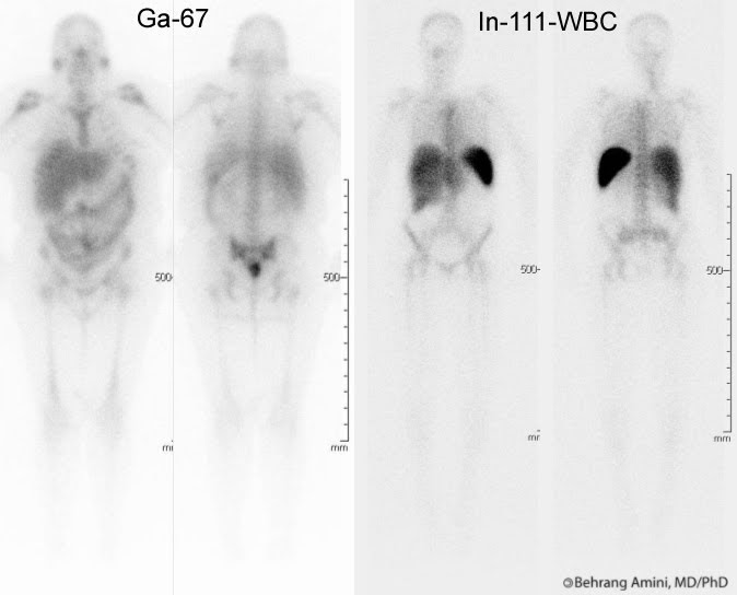 Roentgen Ray Reader: Ga-citrate vs In-WBC