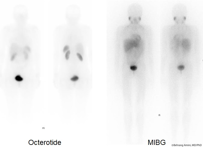 Roentgen Ray Reader: MIBG vs. Octreotide in the Diagnosis of ...