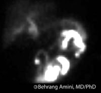 Roentgen Ray Reader: The Rim Sign on HIDA