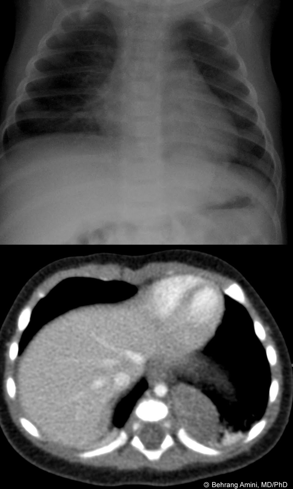 Roentgen Ray Reader: Congenital Pulmonary Airway Malformation