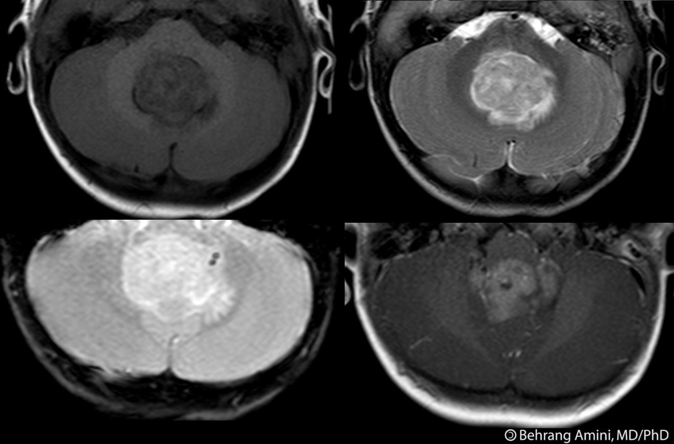 Roentgen Ray Reader: Posterior Fossa Ependymoma