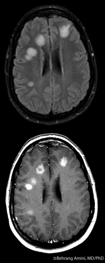 Roentgen Ray Reader: Acute Disseminated Encephalomyelitis
