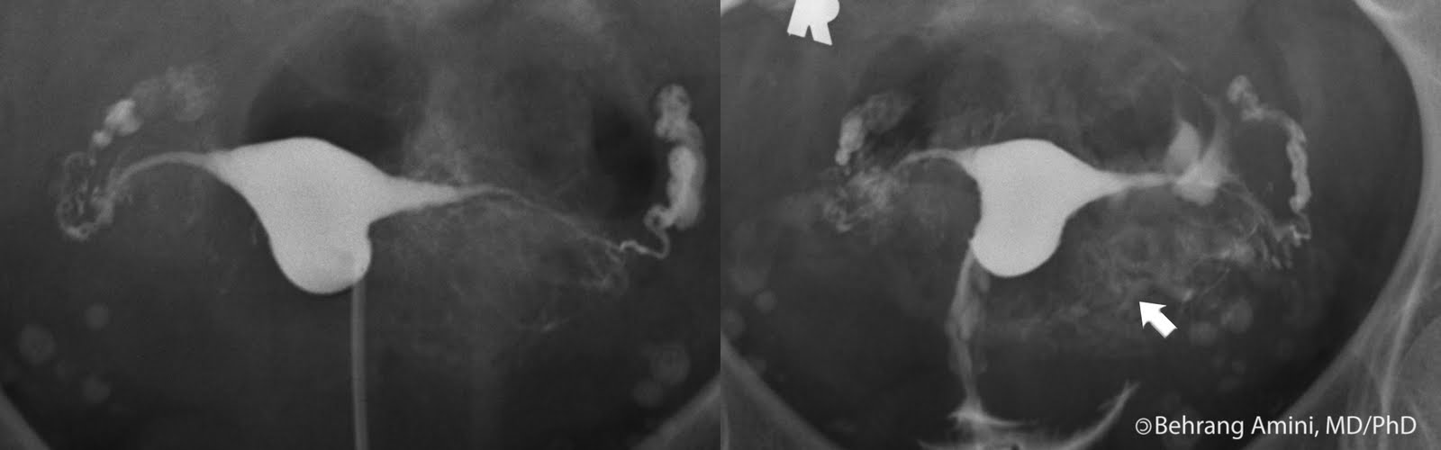 Roentgen Ray Reader: Intravasation on Hysterosalpingography