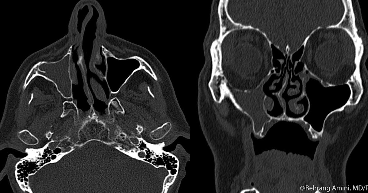 Roentgen Ray Reader: Silent Sinus Syndrome