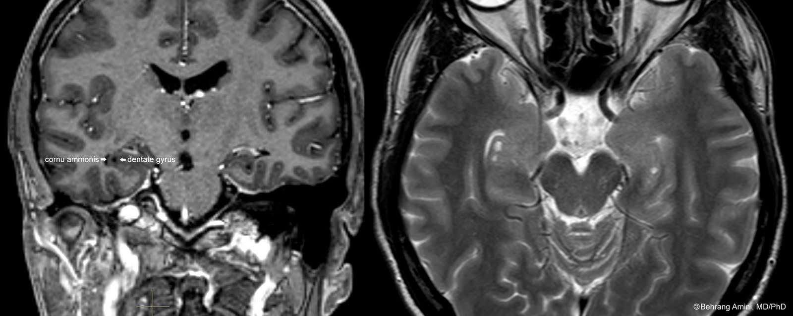 Roentgen Ray Reader: Hippocampal Sulcus Remnant
