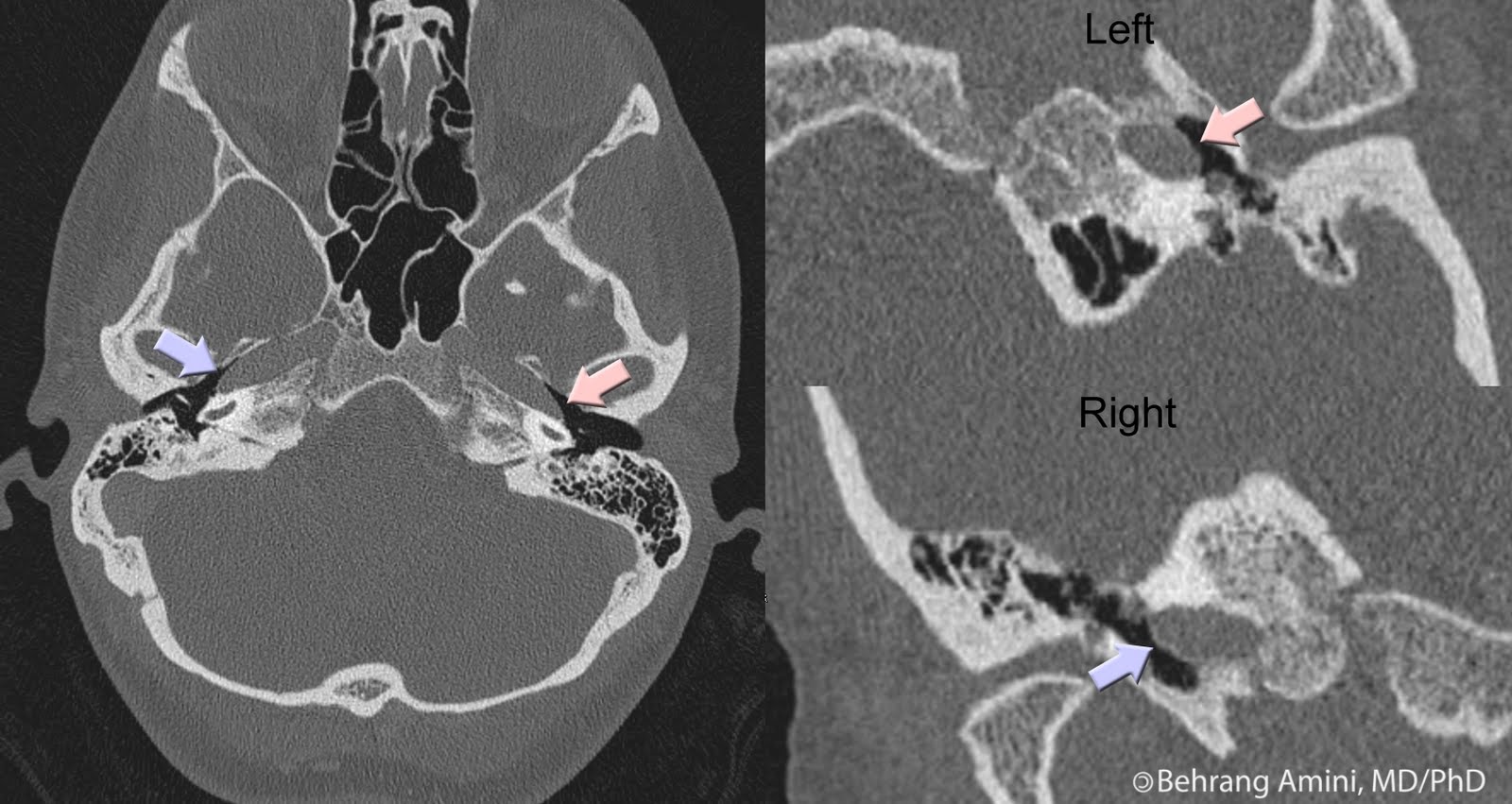 Roentgen Ray Reader: Aberrant vs. Lateralized Internal Carotid Artery