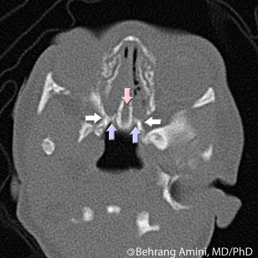 Roentgen Ray Reader: Choanal Atresia