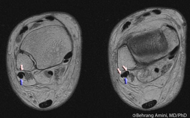 Roentgen Ray Reader: Longitudinal Tear of the Peroneus Brevis Tendon