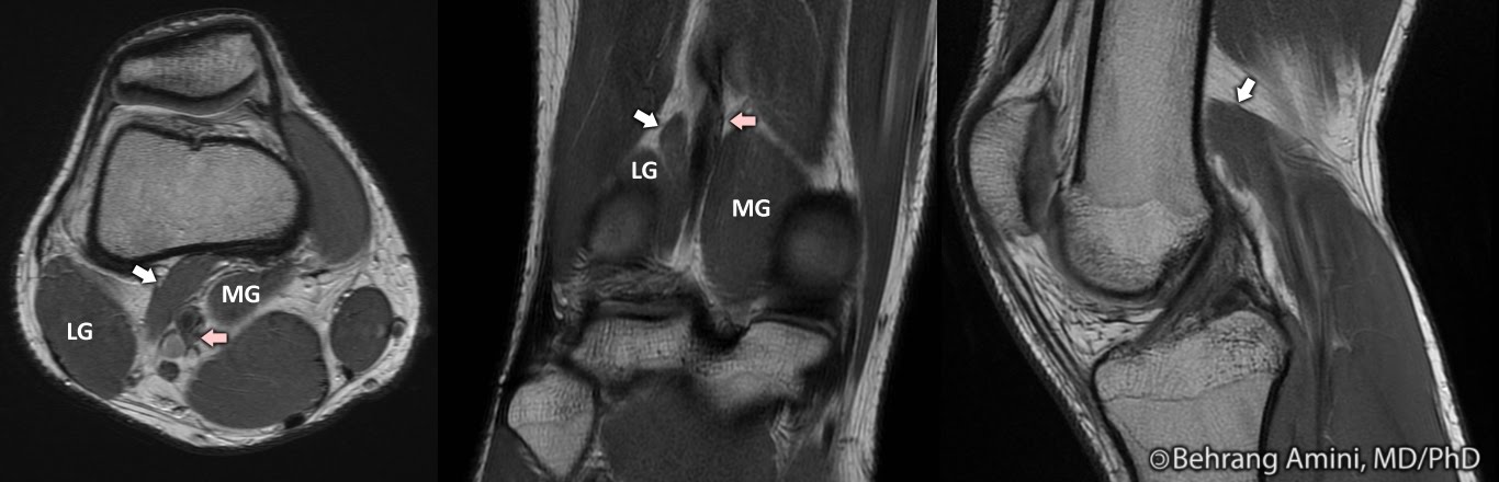 Roentgen Ray Reader: Medial Accessory Anomalous Origin of the Lateral ...
