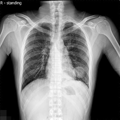 CXR 胸部x光判讀 lung abscess