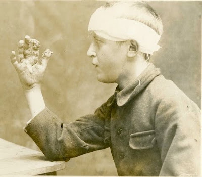 mdolla: 20 gnarly old school war wounds
