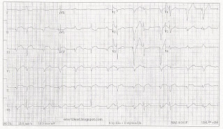 Discordant ST-Segment Elevation in LBBB or Paced Rhythm | Paramedicine 101
