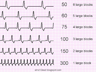 Large block method for heart rate calculation | EMS 12 Lead