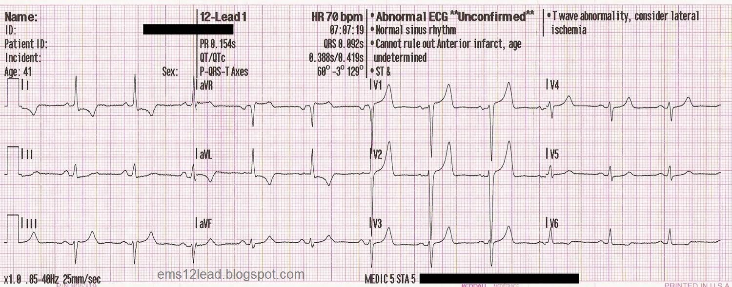 Left Ventricular Hypertrophy | EMS 12 Lead